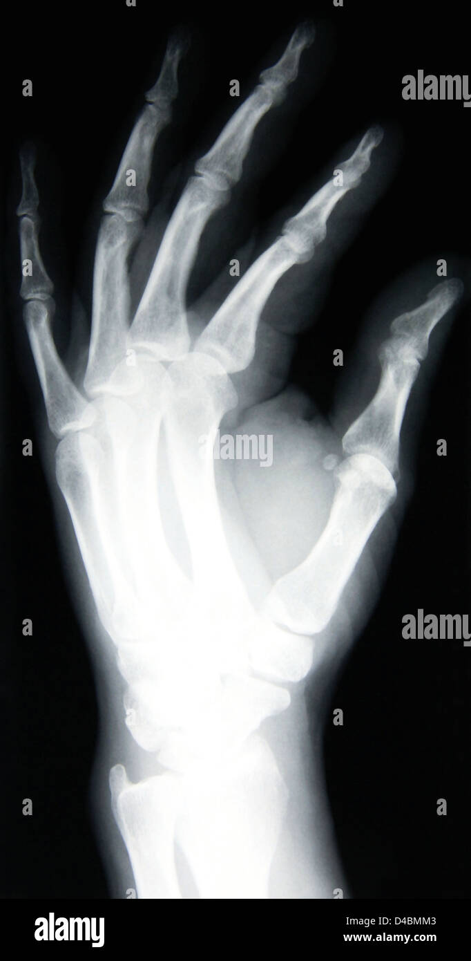 X-ray image of female hand Stock Photo - Alamy