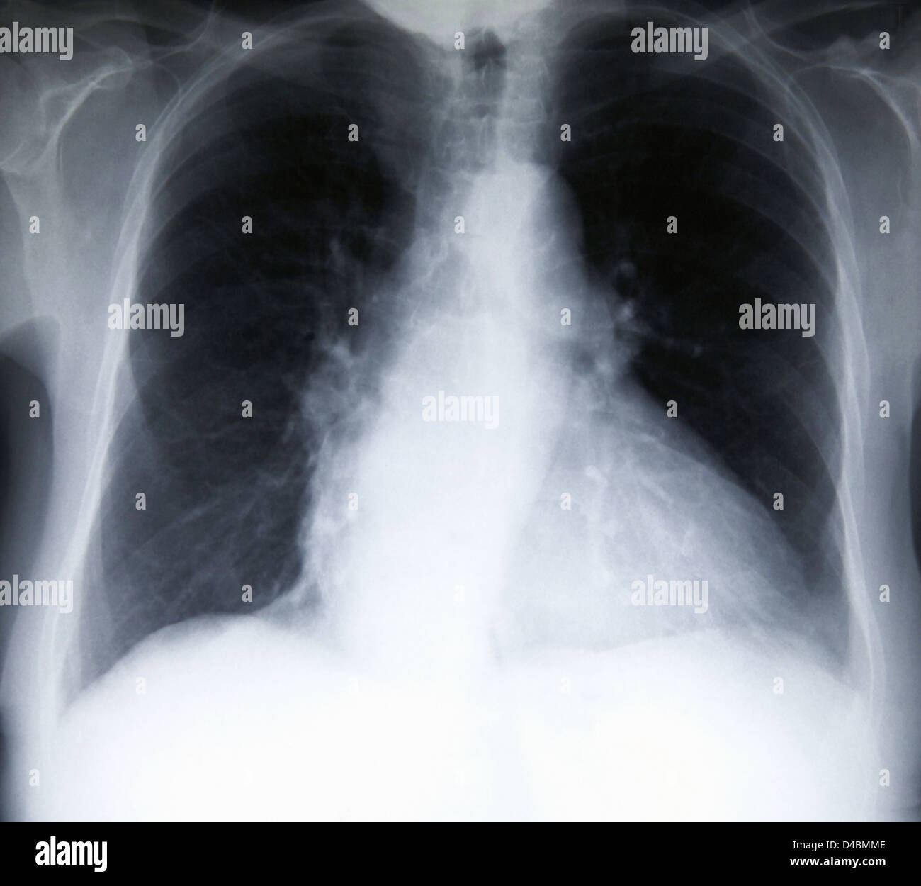 X-ray image of female chest, sternam, rib cage and spine Stock Photo ...
