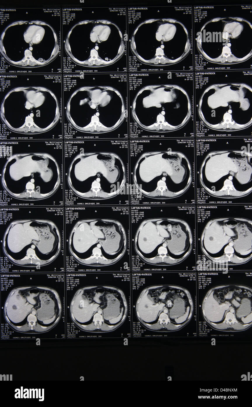 The mri scans made upon cerebral cortex hi-res stock photography and ...