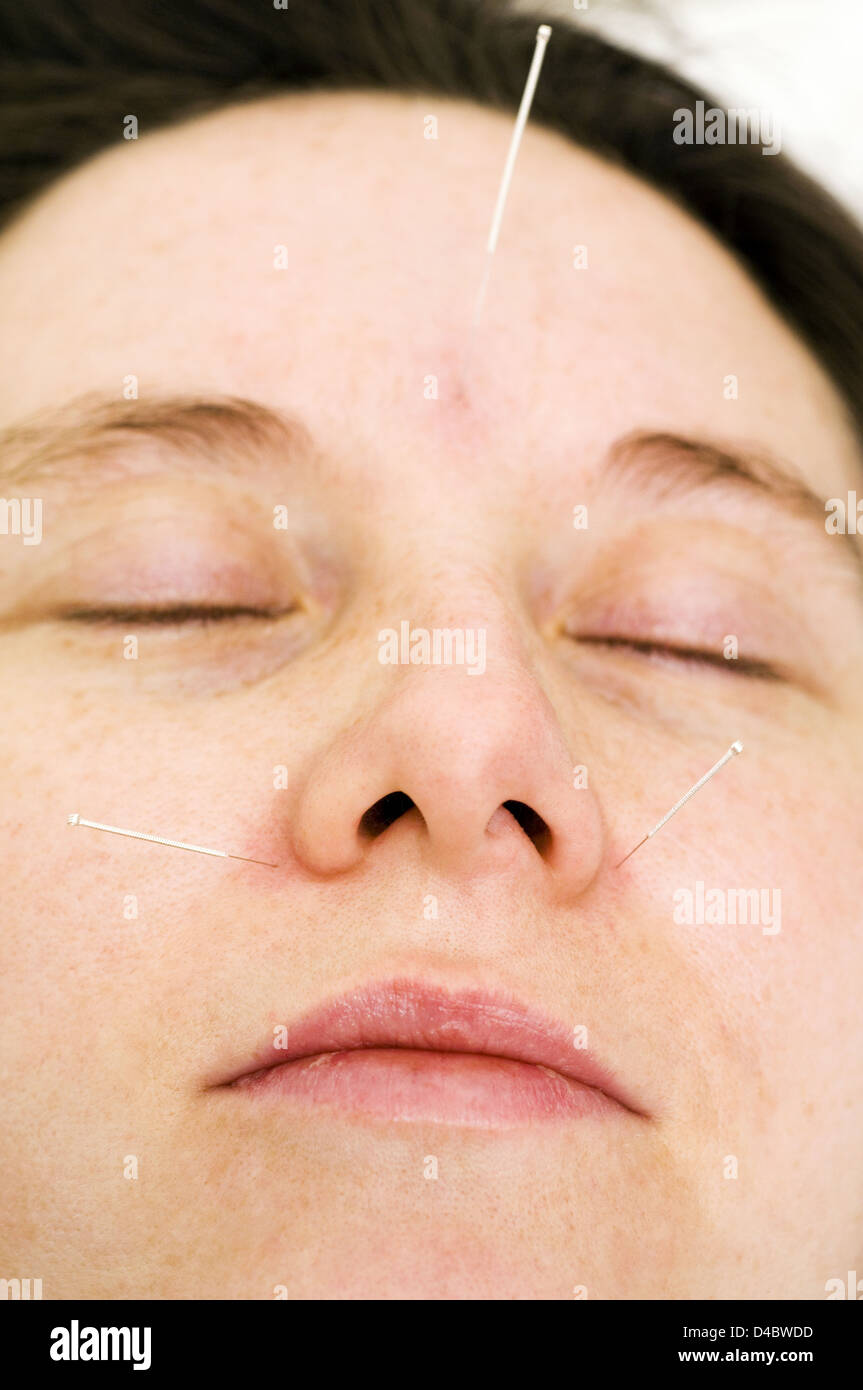 Acupuncture needles, as fine as hair, being inserted into the forehead ...