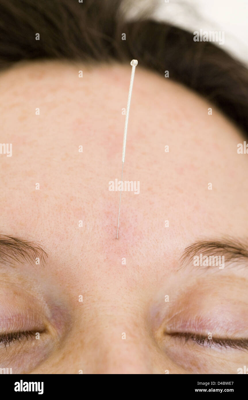 Acupuncture needles, as fine as hair, being inserted into the forehead ...
