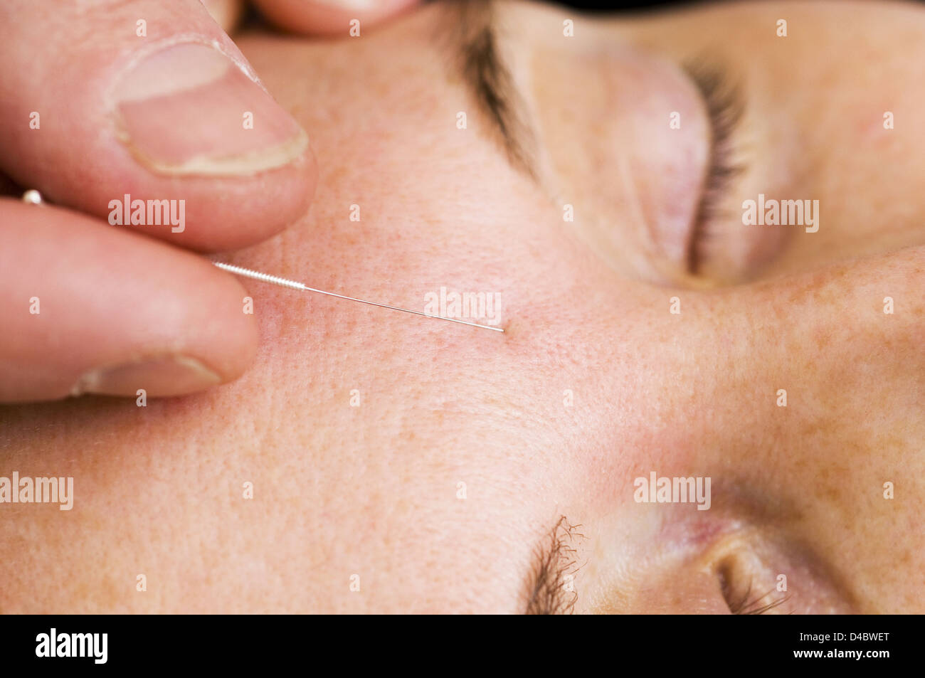Acupuncture needles, as fine as hair, being inserted into the forehead ...
