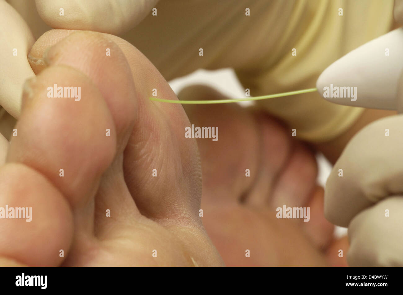 Podiatrist performs foot sensitivity test on patient Stock Photo - Alamy