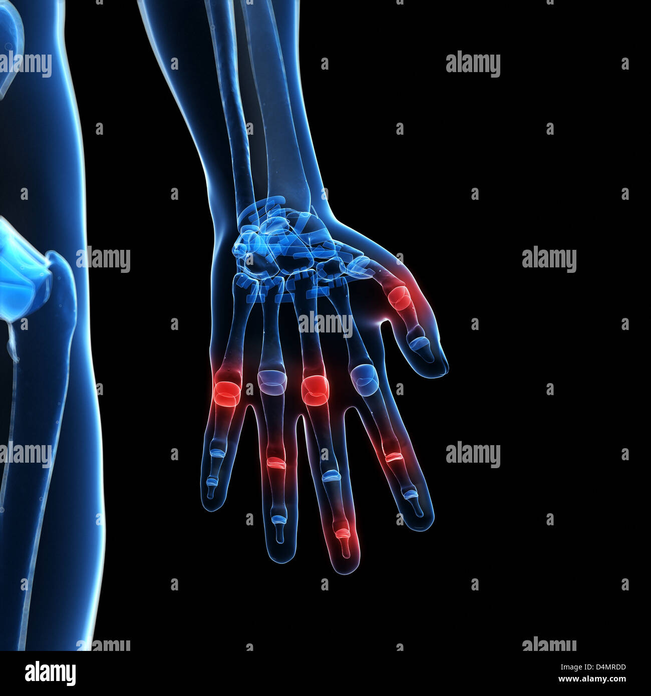 X-ray hand - arthritis Stock Photo - Alamy