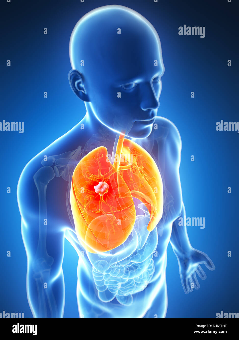 Male lung - cancer Stock Photo - Alamy