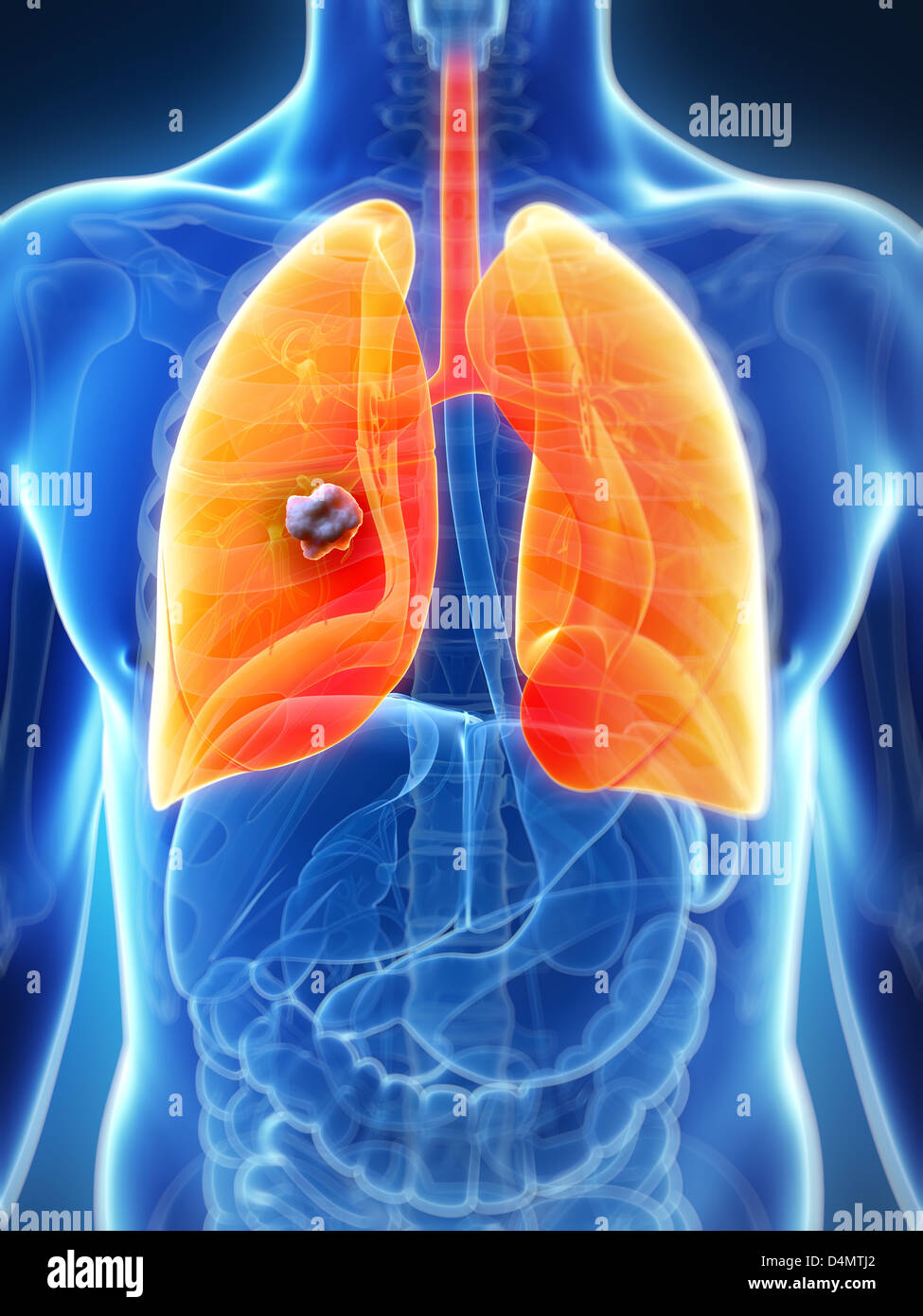 Male lung - cancer Stock Photo - Alamy