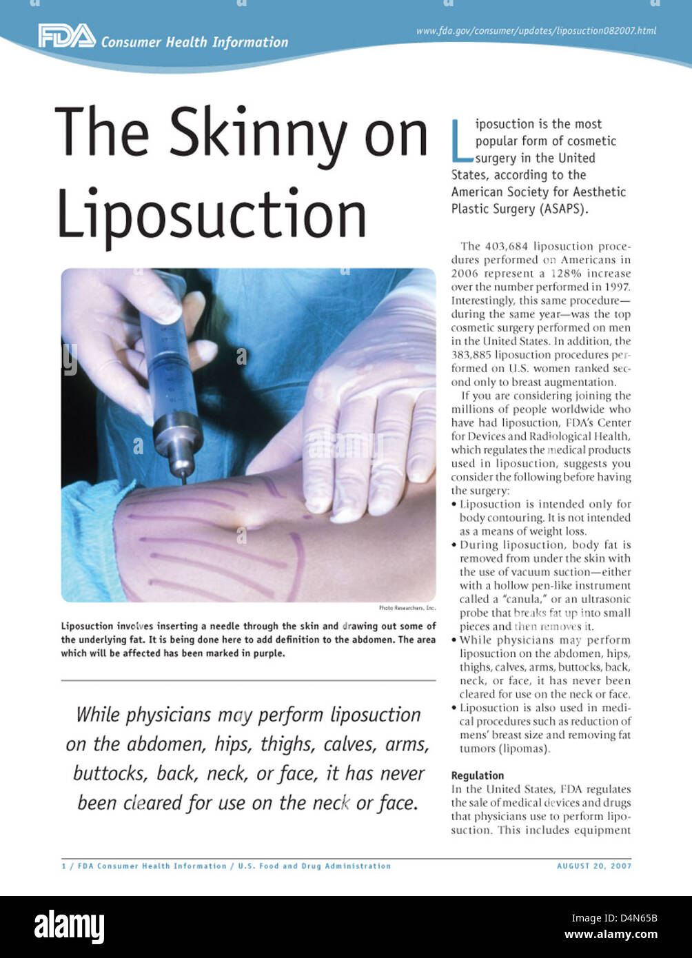 Liposuction is a cosmetic procedure used to remove excess fat from ...