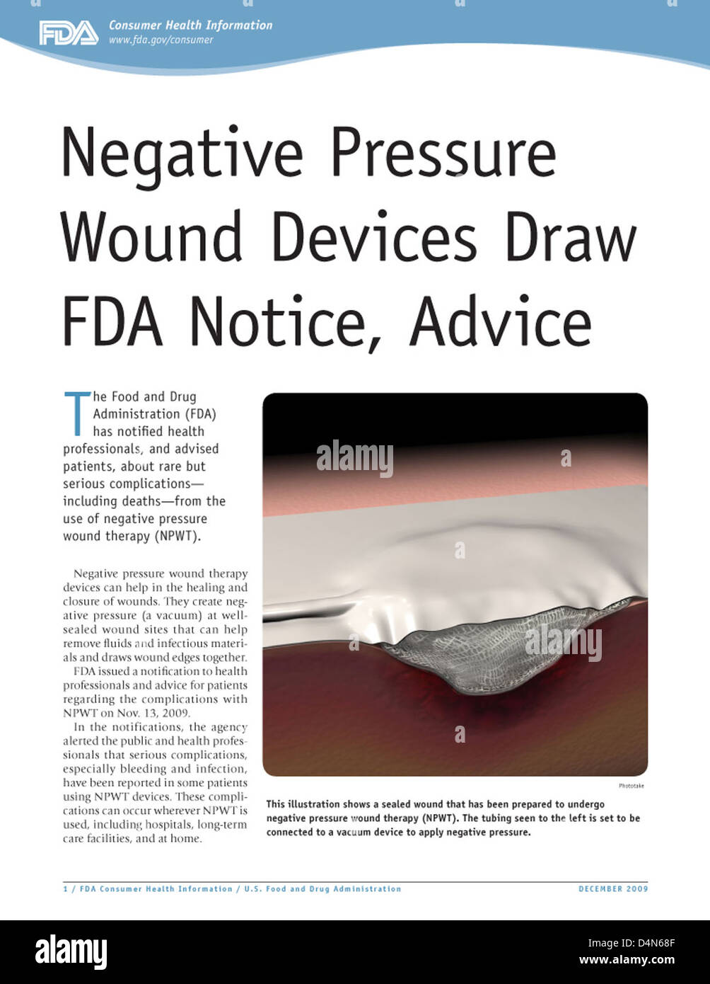 Negative pressure wound therapy hi-res stock photography and images - Alamy