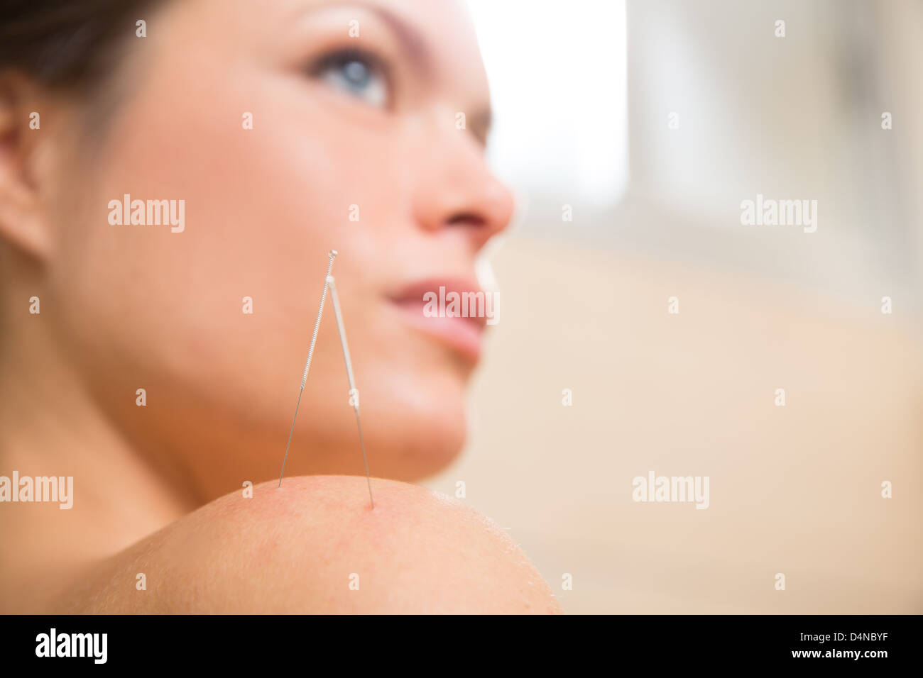 Acupuncture needle pricking on woman shoulder therapy closeup Stock ...