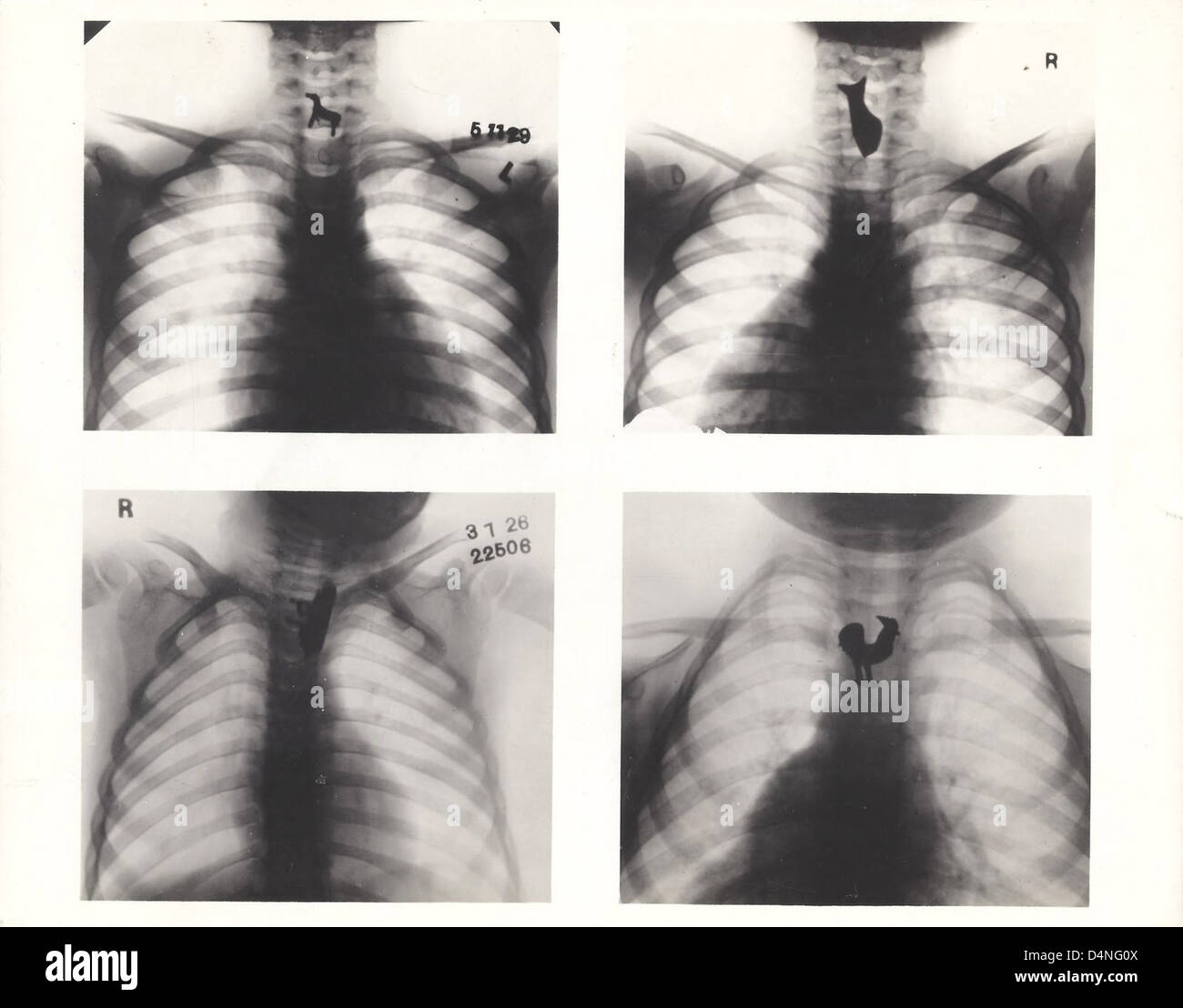 An X-ray taken in 1933 by Dr. Chevalier Jackson, a renowned ...