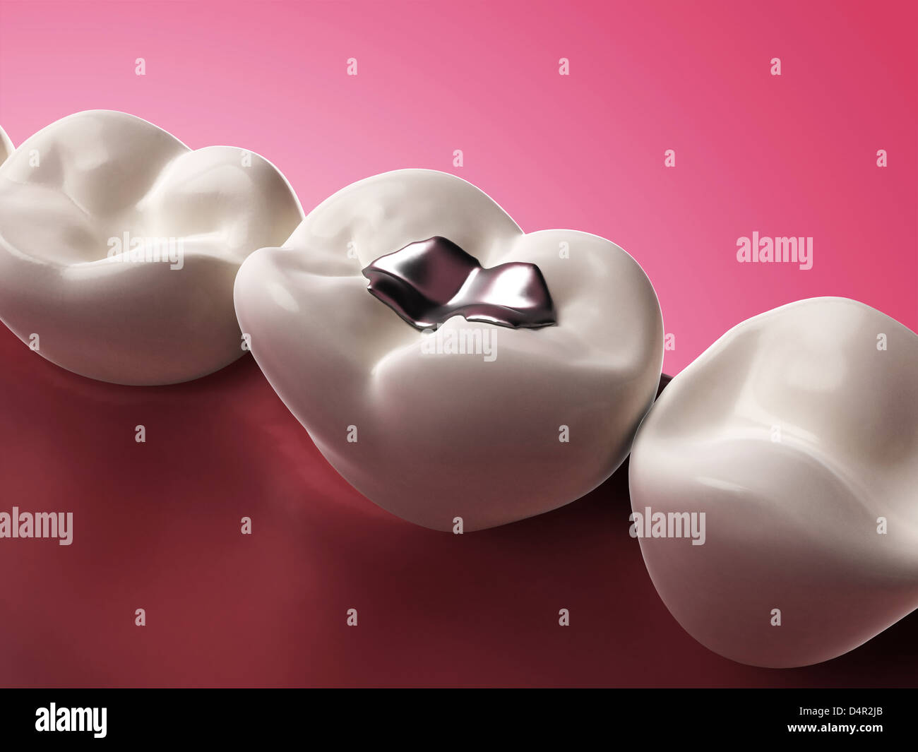 3d rendered illustration of an amalgam filling Stock Photo - Alamy