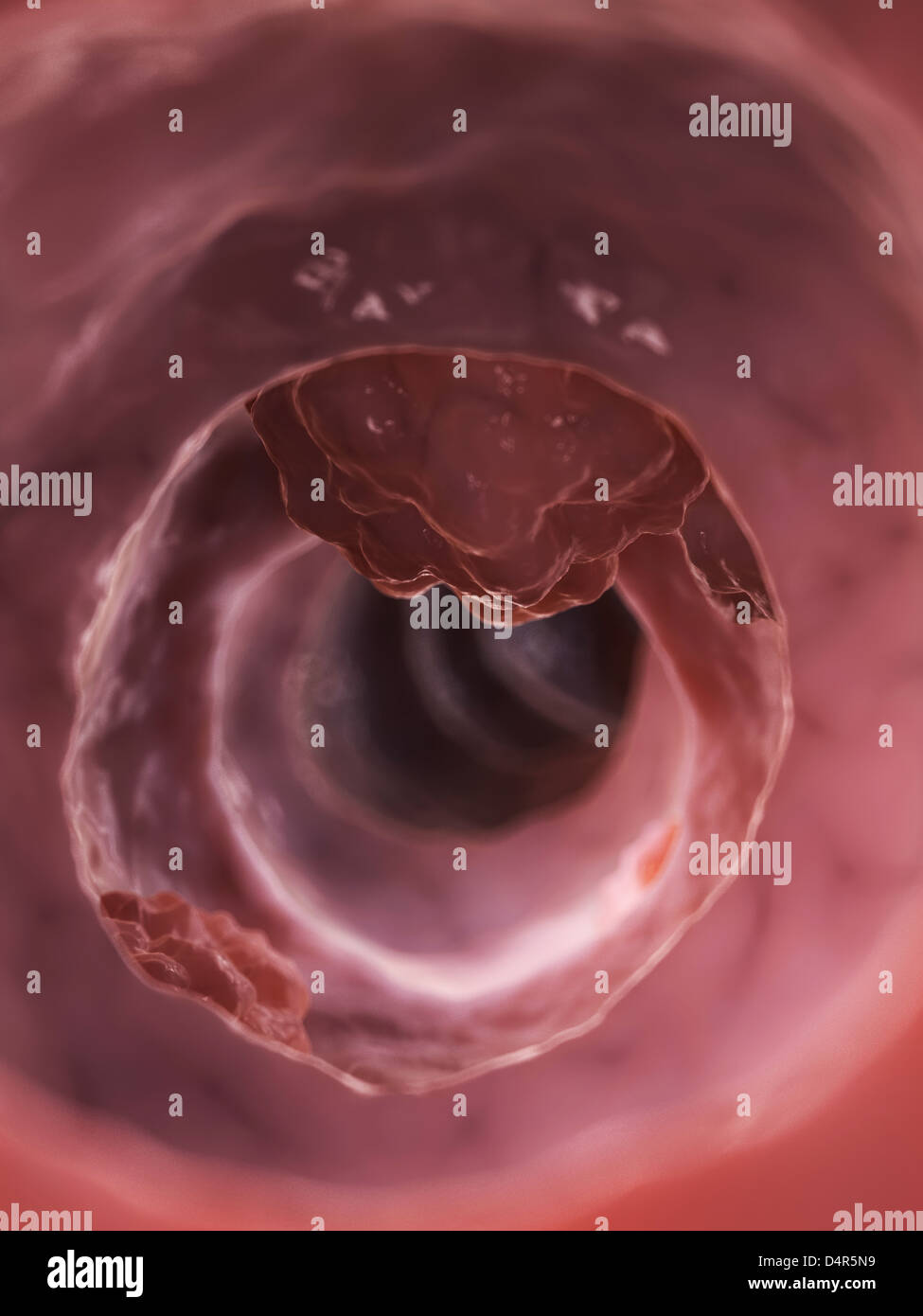 Colon Polyp Stock Photos & Colon Polyp Stock Images - Alamy