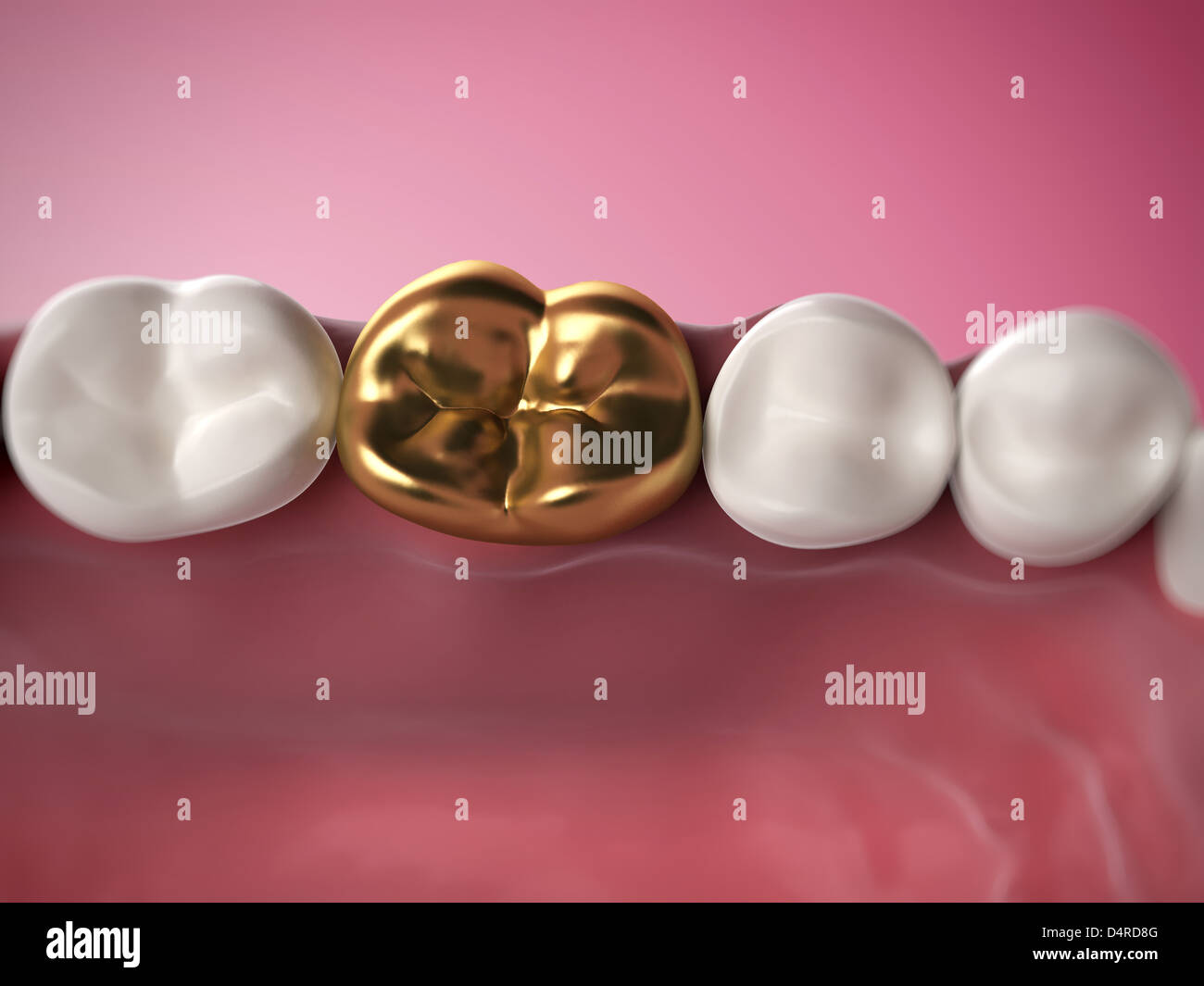 Gold crown tooth hi-res stock photography and images - Alamy