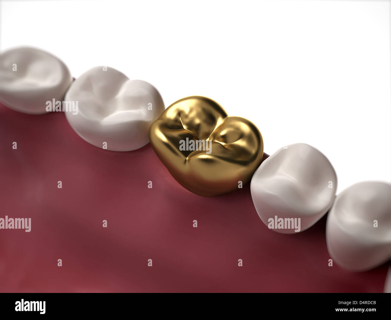 Gold crown tooth hi-res stock photography and images - Alamy