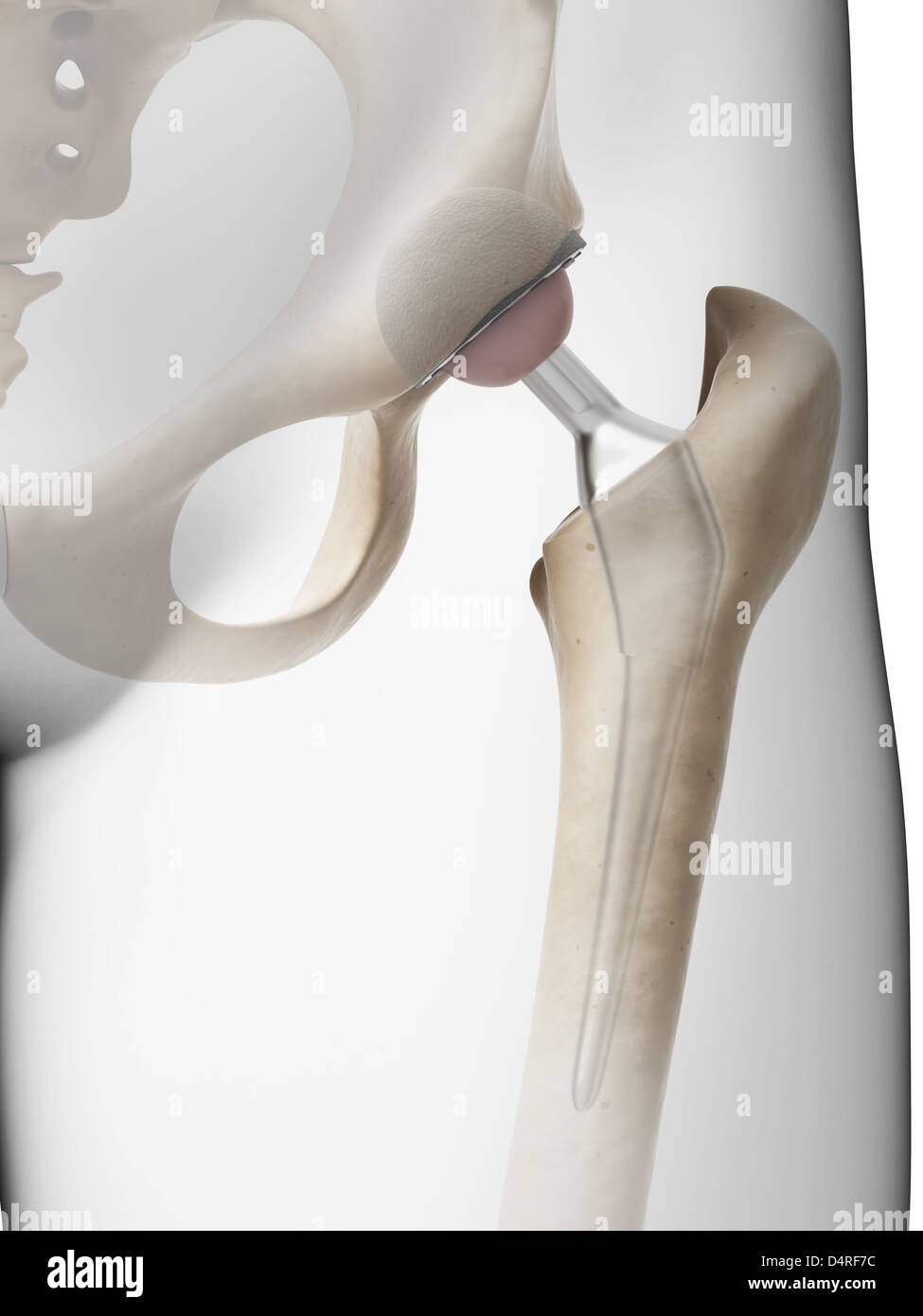 Femoral head replacement hi-res stock photography and images - Alamy