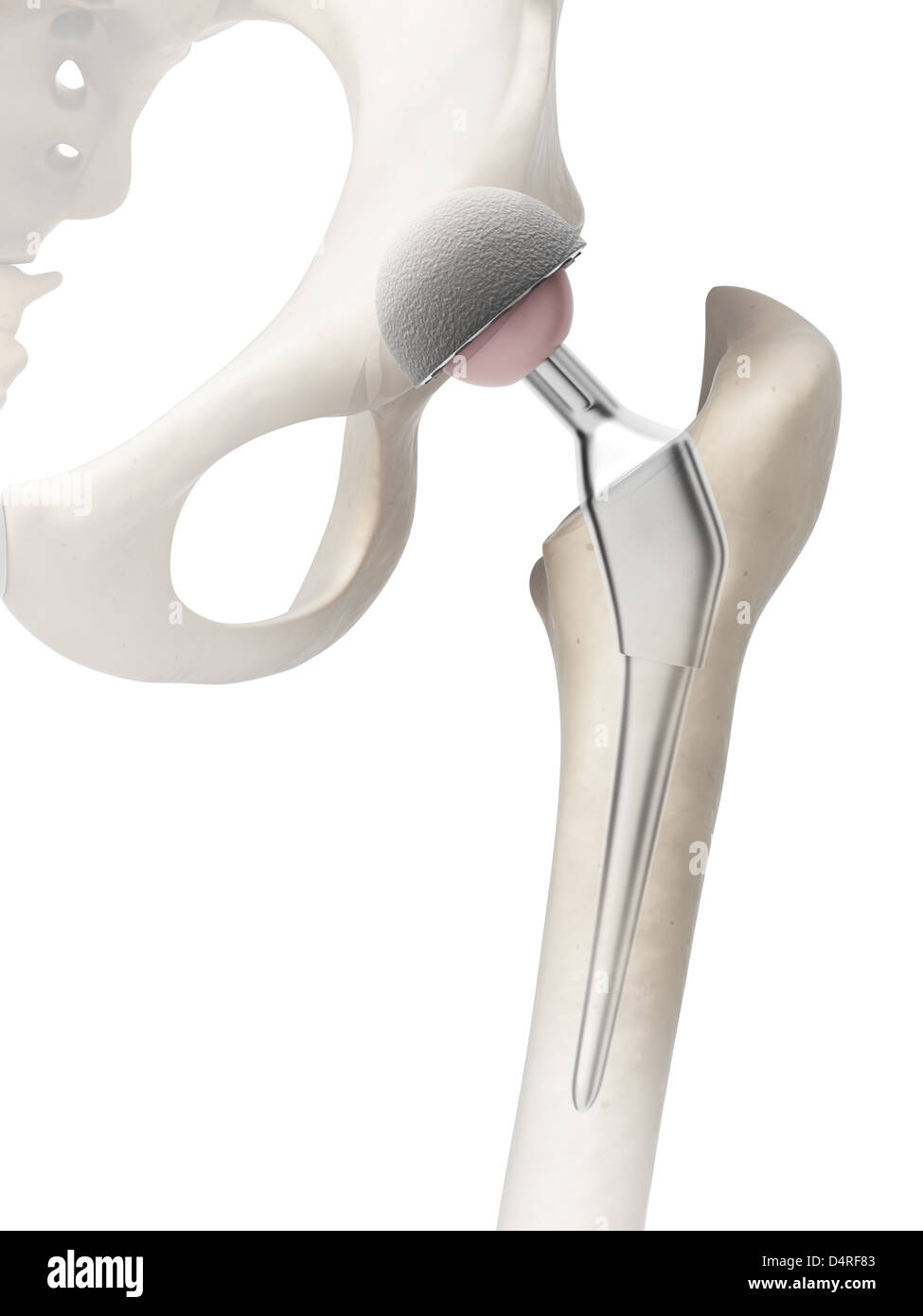 Artificial femoral head hi-res stock photography and images - Alamy