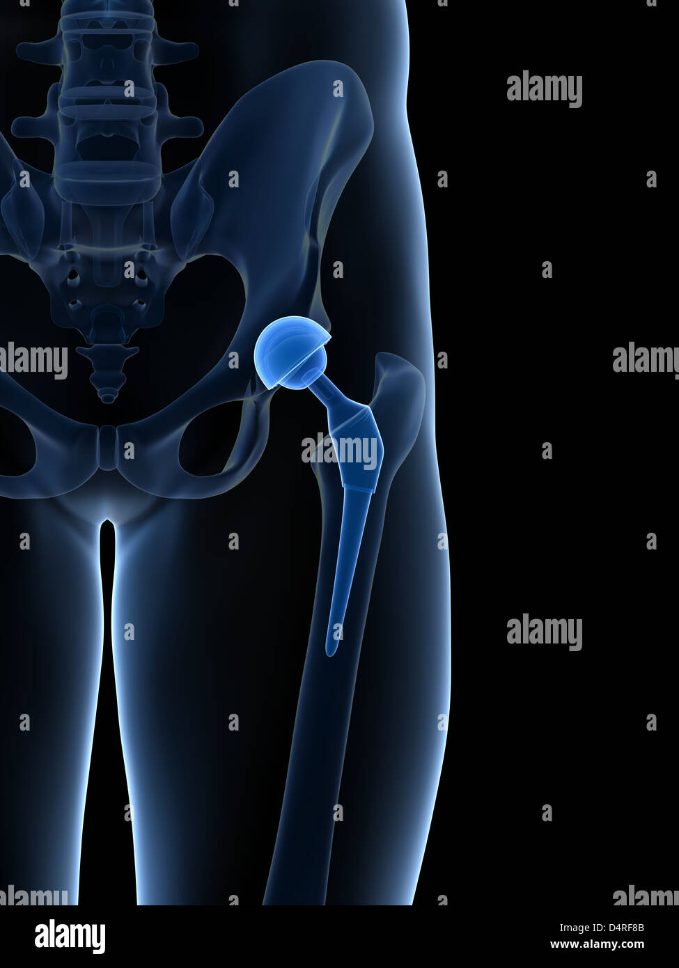 Total hip replacement hi-res stock photography and images - Alamy