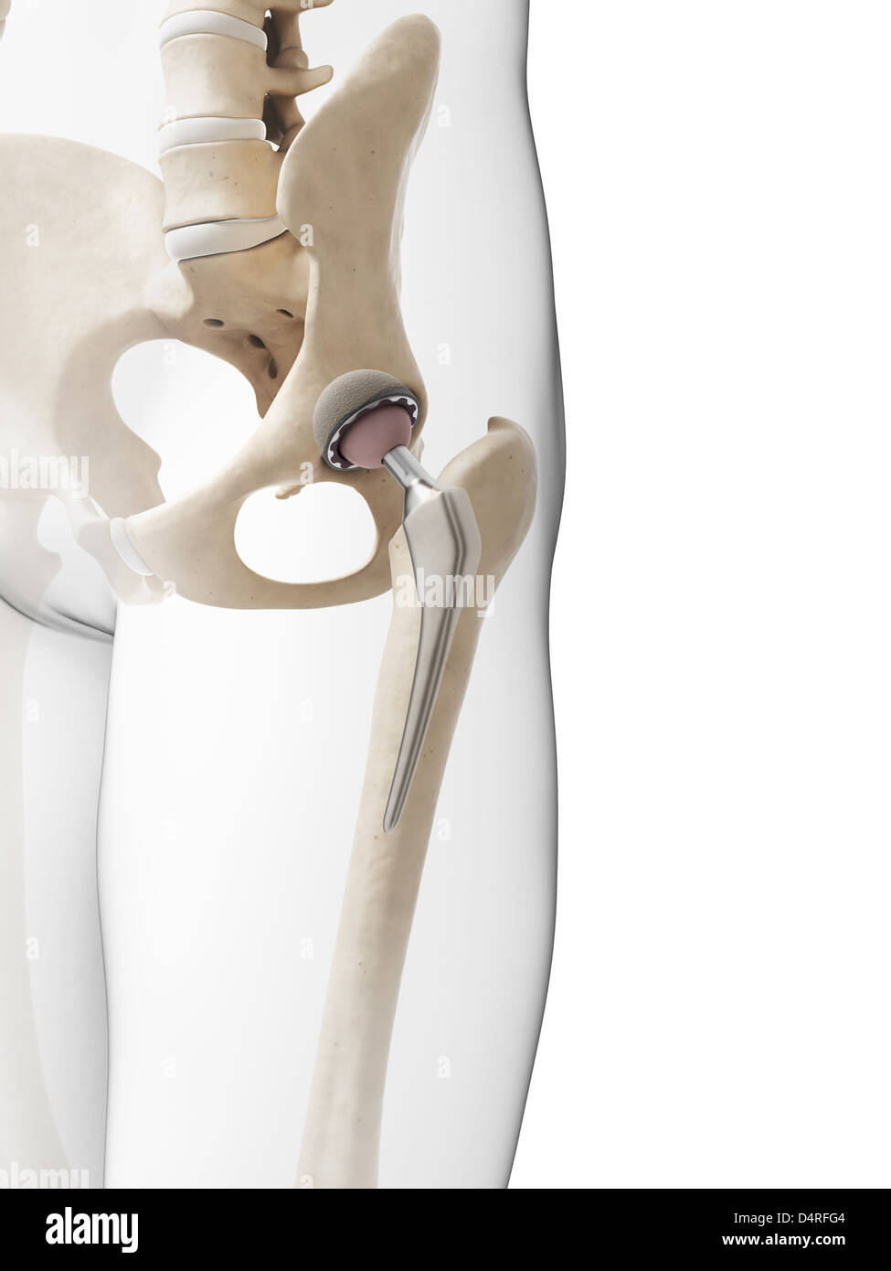 Total hip replacement hi-res stock photography and images - Alamy