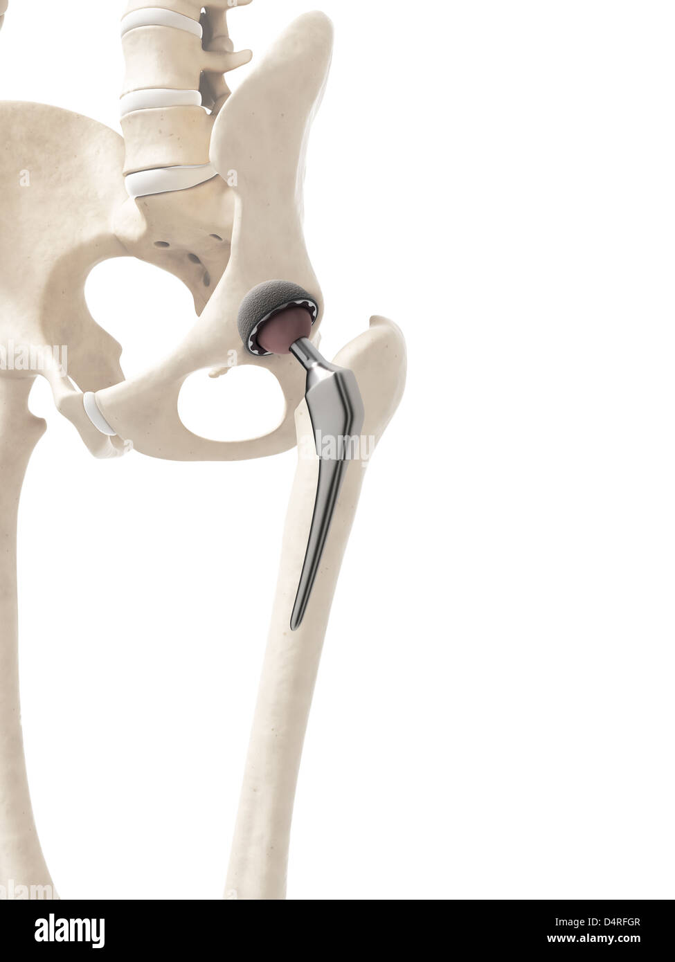 Total hip replacement hi-res stock photography and images - Alamy