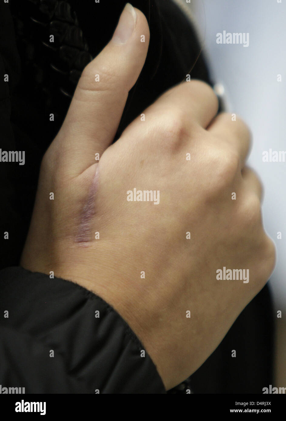The scarred hand of witness Anna P. pictured in the district court in ...
