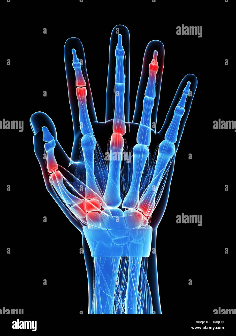 x-ray hand - arthritis Stock Photo - Alamy