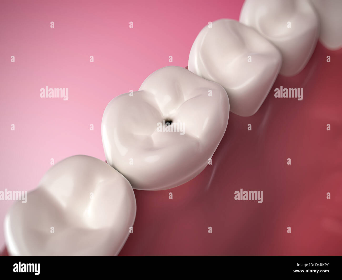 Tooth decay hi-res stock photography and images - Alamy