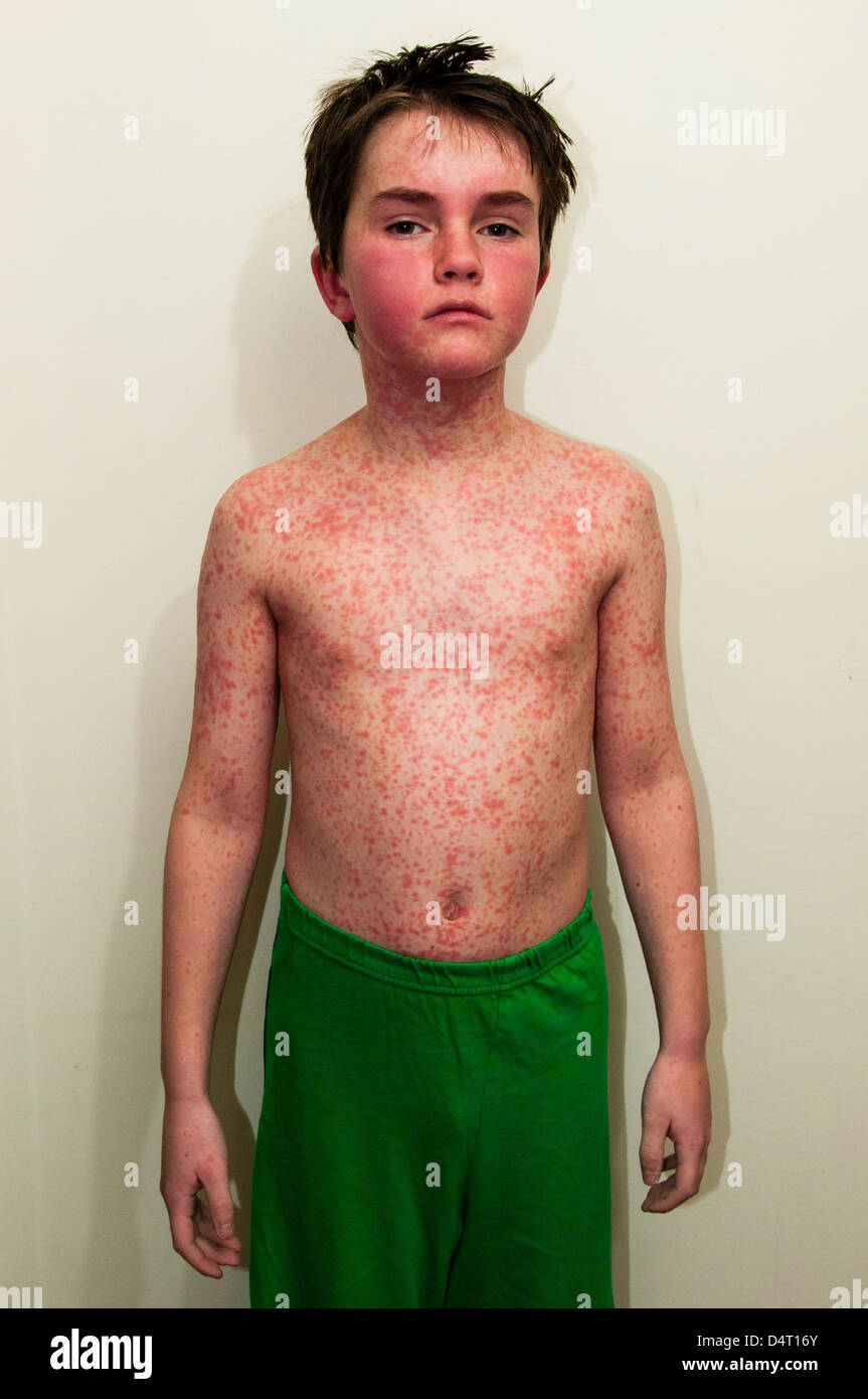 Skin spots hi-res stock photography and images - Alamy