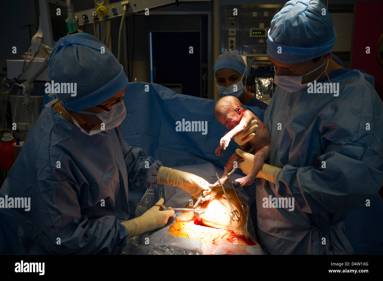 umbilical cord ,Cesarean in a hospital.a newborn in operating room ...