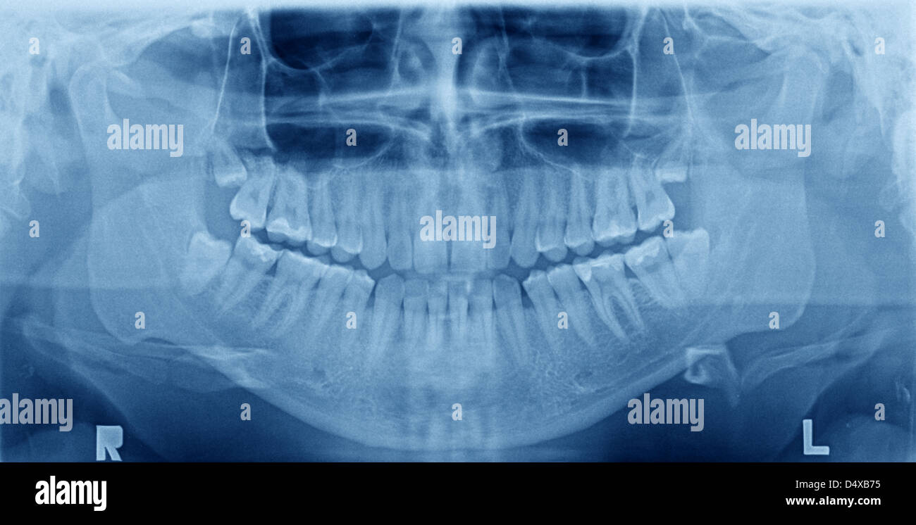 Panoramic x-ray image of teeth. Problem with wisdom tooth Stock Photo ...