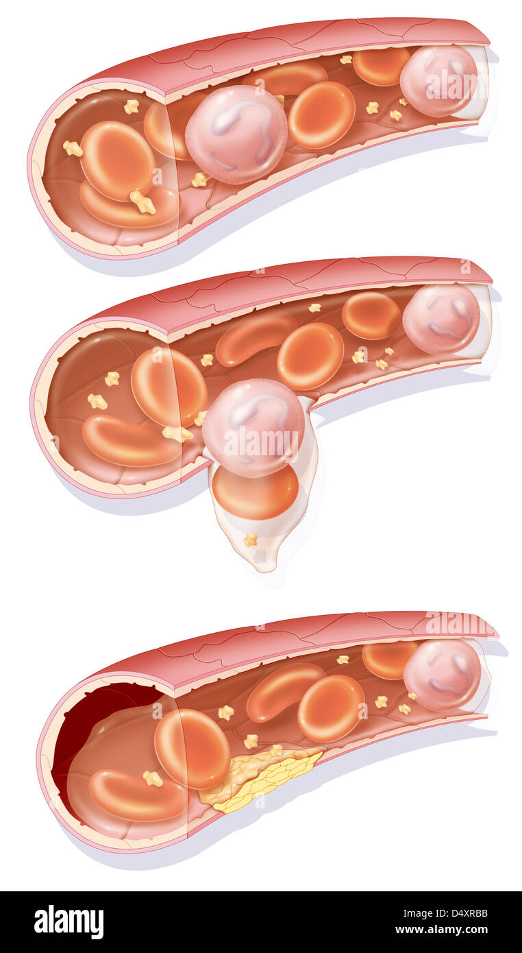 Platelet aggregations hi-res stock photography and images - Alamy