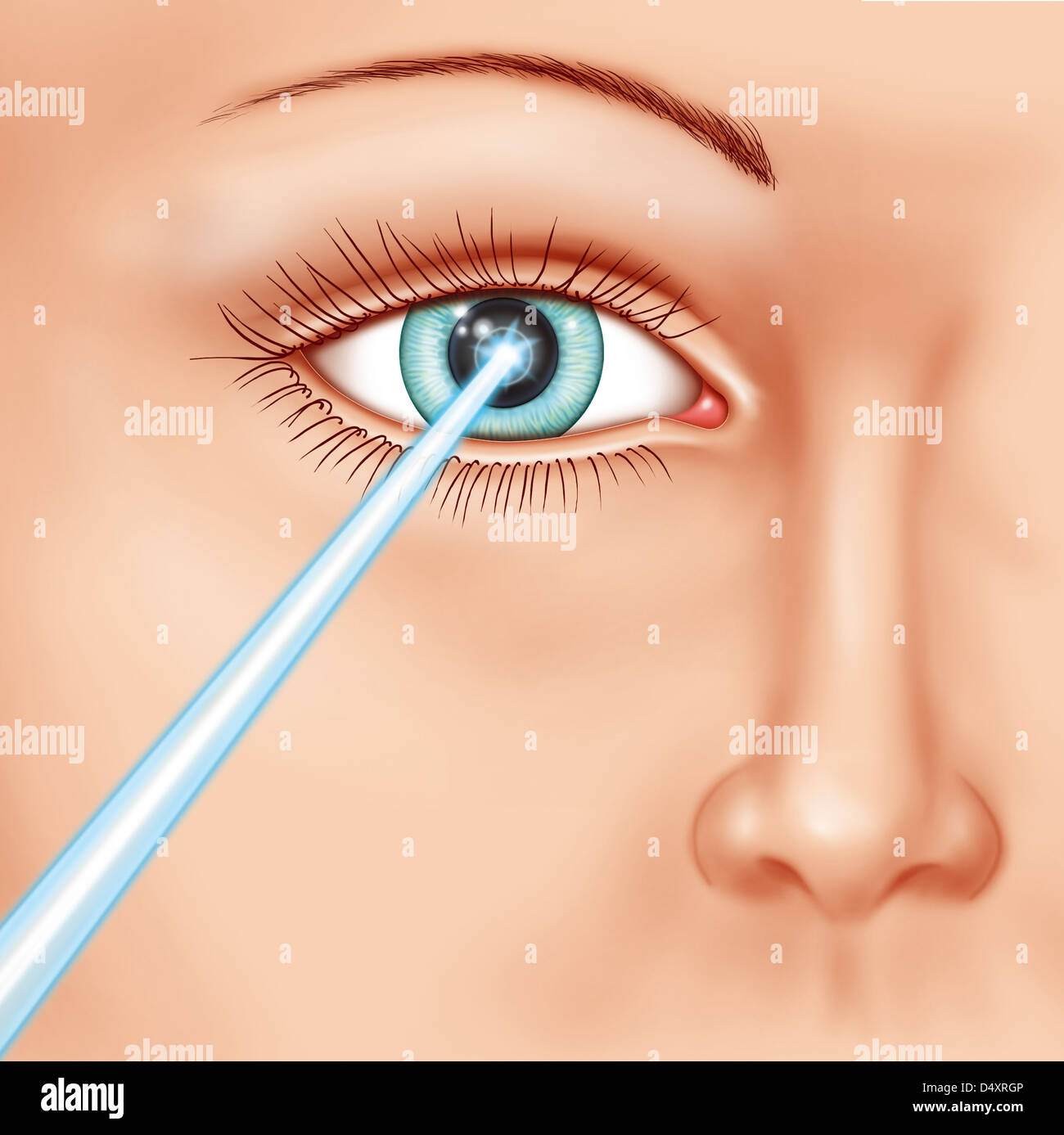 EYE SURGERY, DRAWING Stock Photo - Alamy
