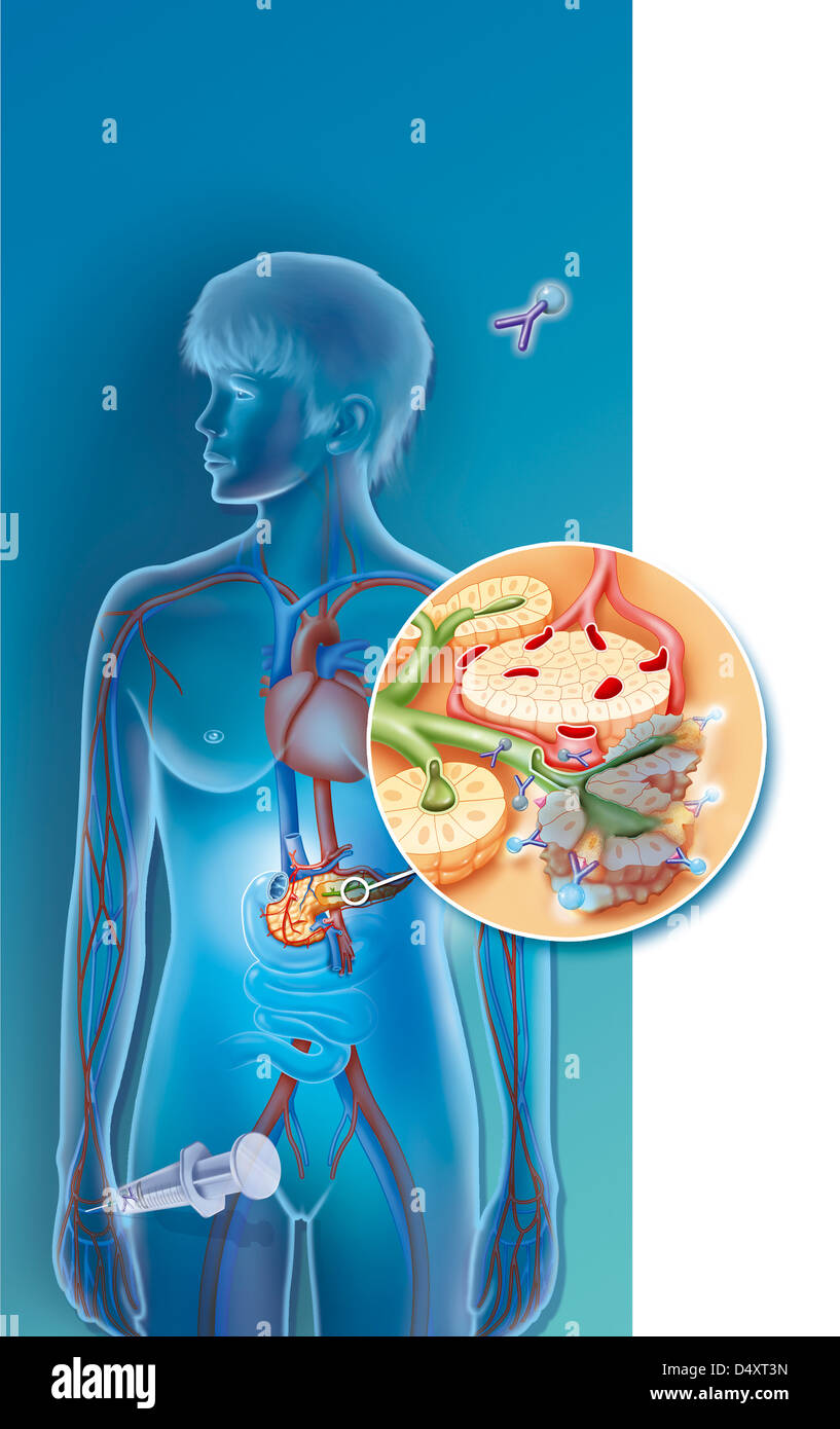 Radio immunotherapy hi-res stock photography and images - Alamy