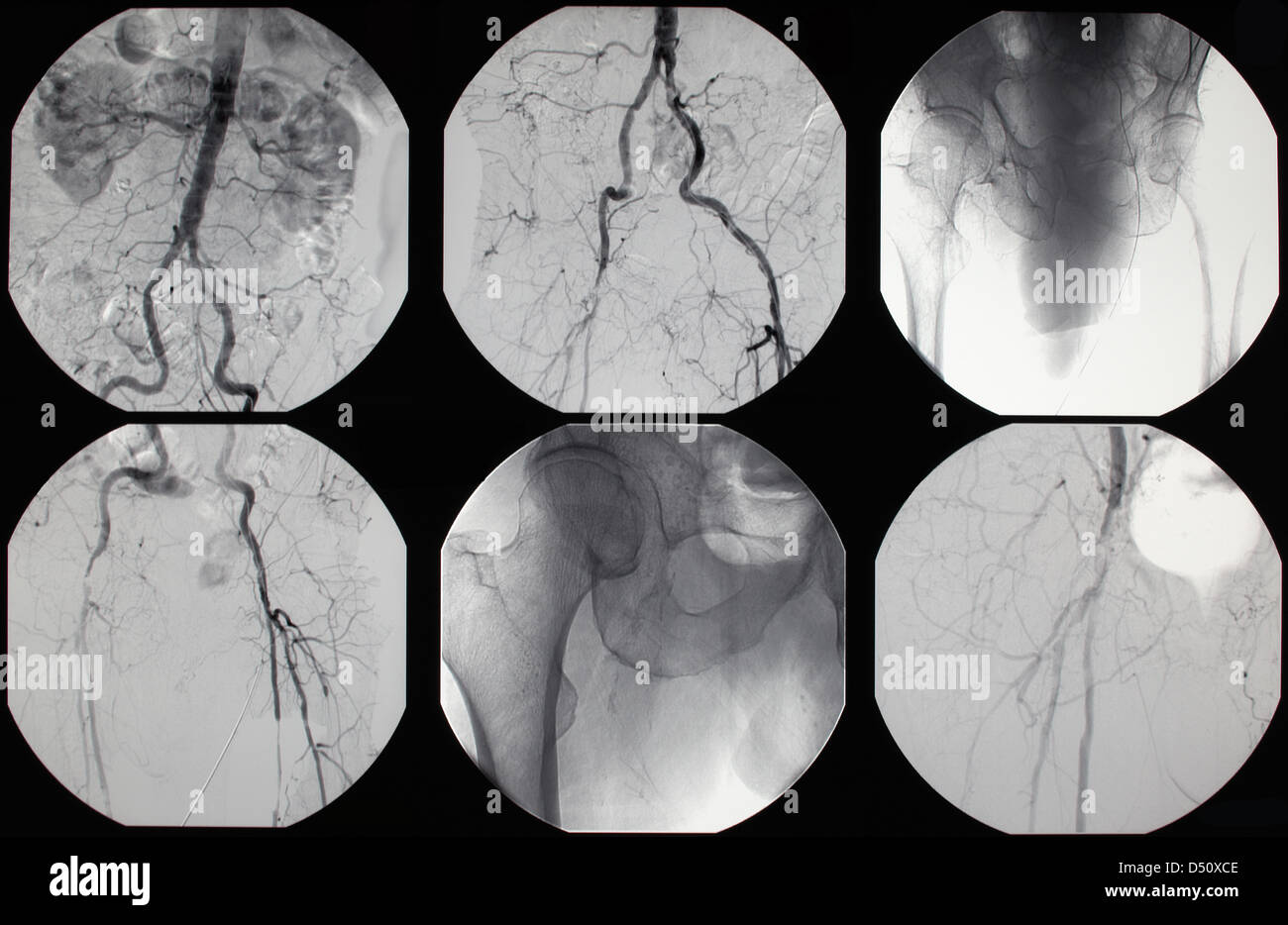 Digital subtraction angiography hi-res stock photography and images - Alamy