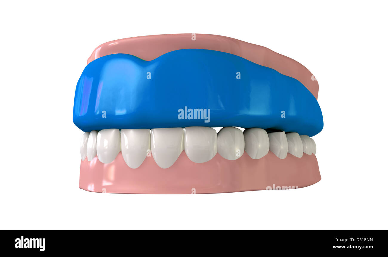 A perspective view of a regular blue sports gum guard fitted to a set ...