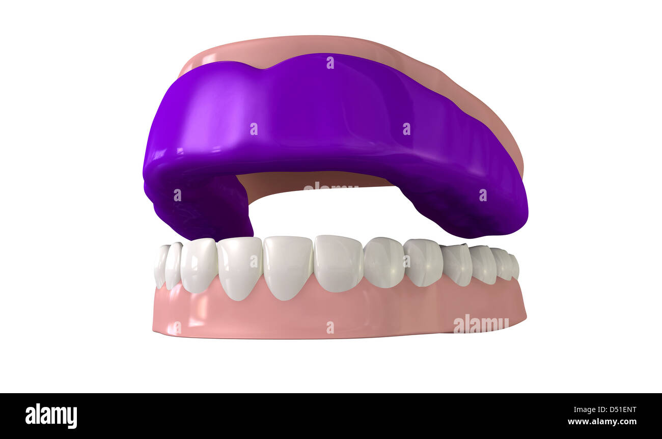 A perspective view of a regular blue sports gum guard fitted to a set ...
