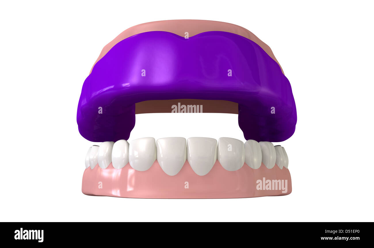 A front view of a regular blue sports gum guard fitted to a set of open ...