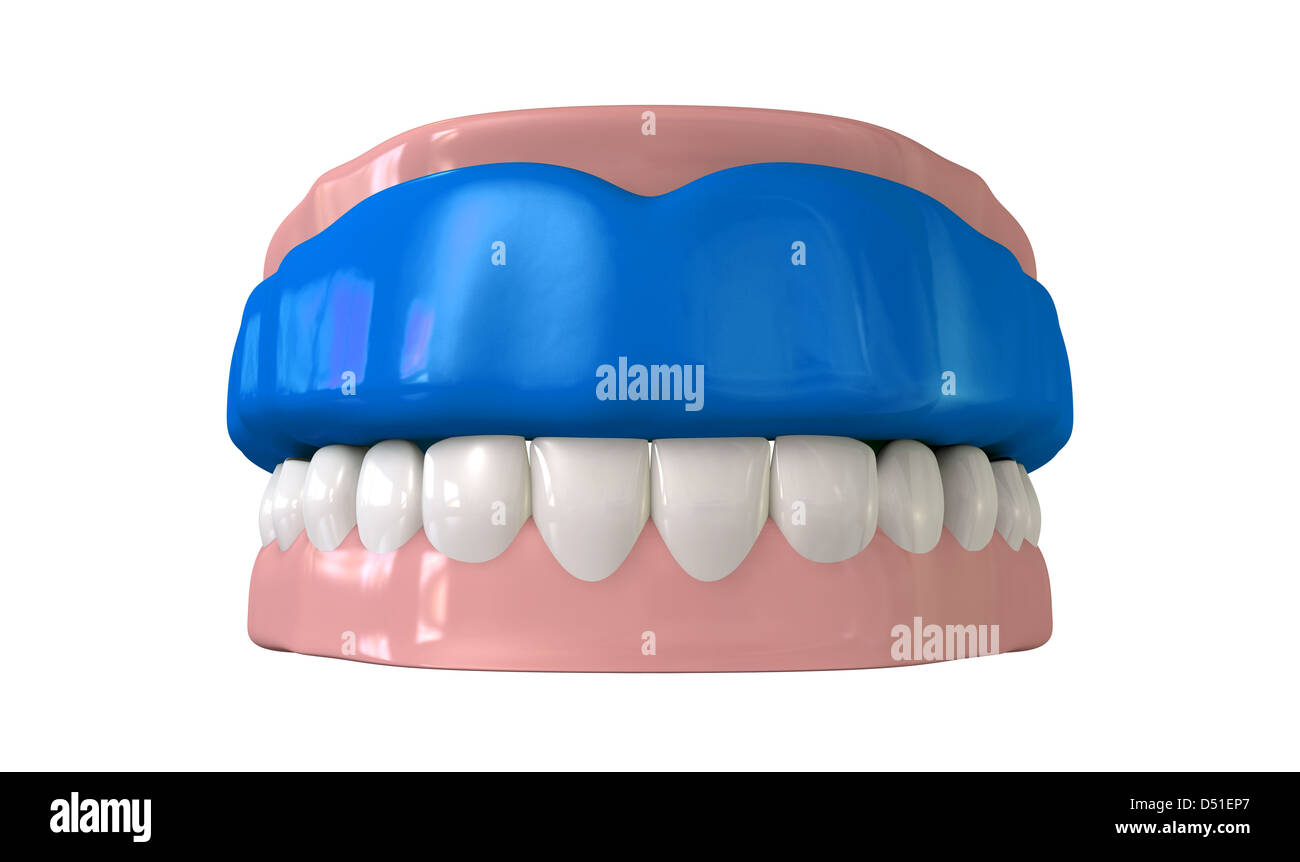 A front view of a regular blue sports gum guard fitted to a set of ...