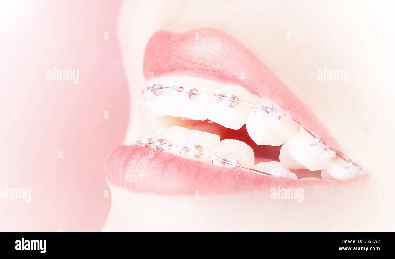 Happy smiling girl with braces, face part, teeth straighten, tooth ...