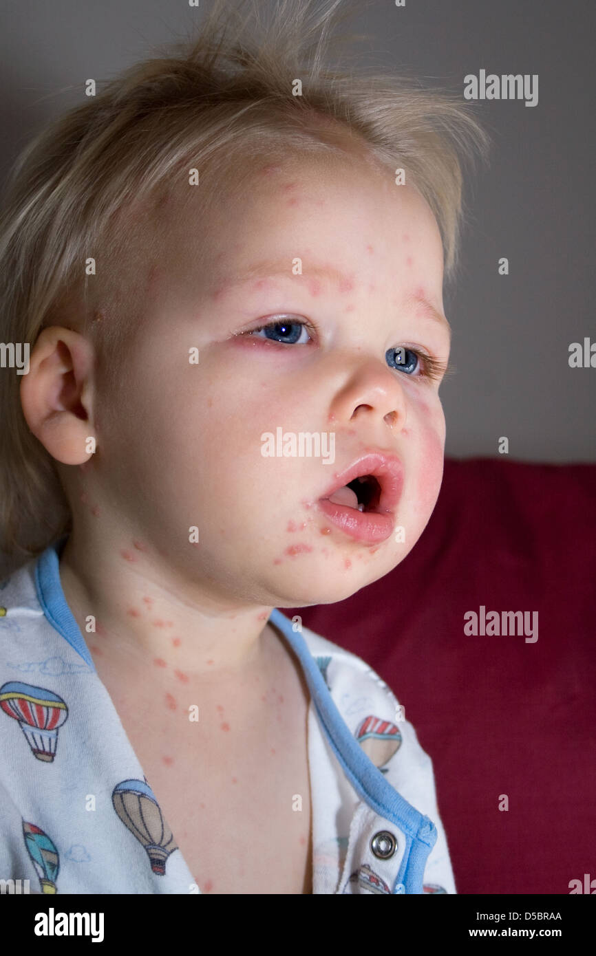 Chicken Pox Child High Resolution Stock Photography and Images - Alamy