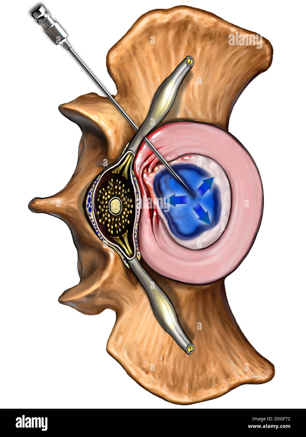 Lumbar Disc Herniation L5 S1 High Resolution Stock Photography and ...