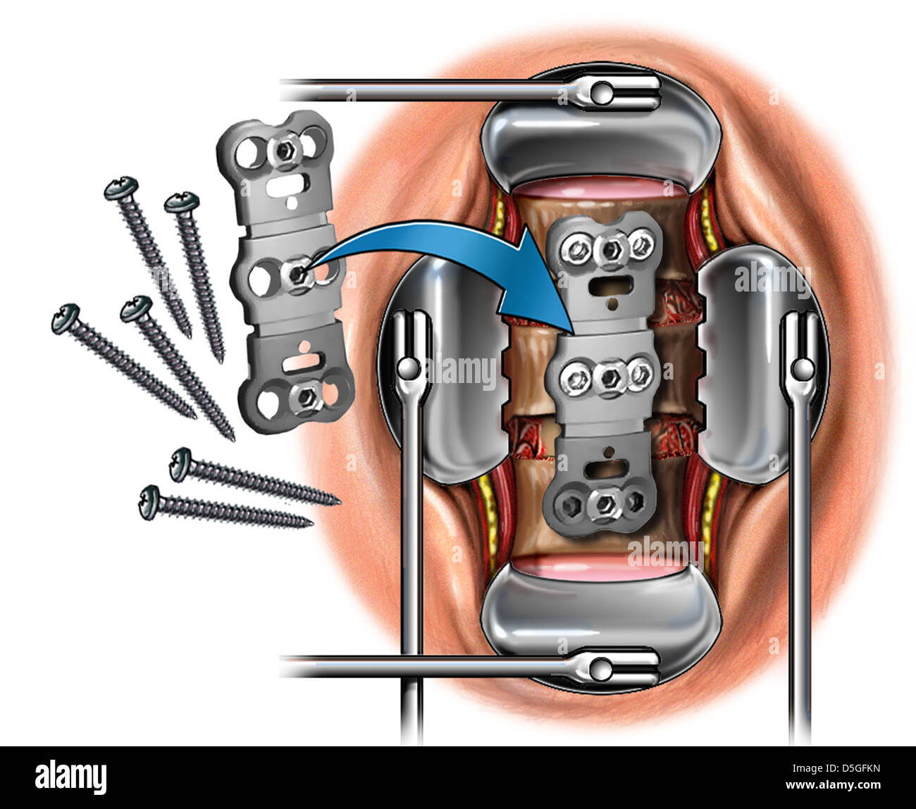 Anterior cervical discectomy hi-res stock photography and images - Alamy