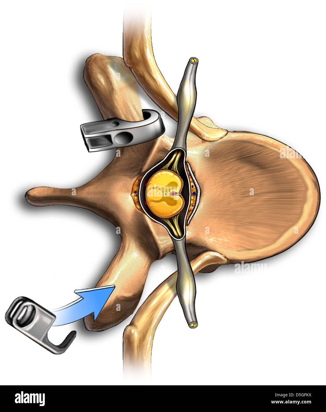 Pedicle hi-res stock photography and images - Alamy