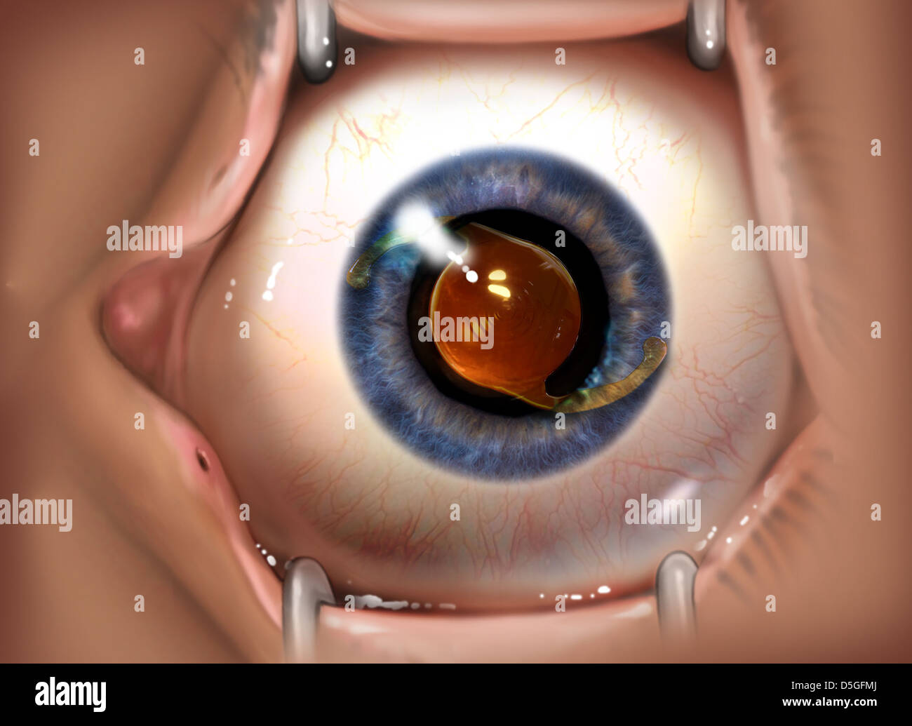 Anterior chamber intraocular lens hi-res stock photography and images ...
