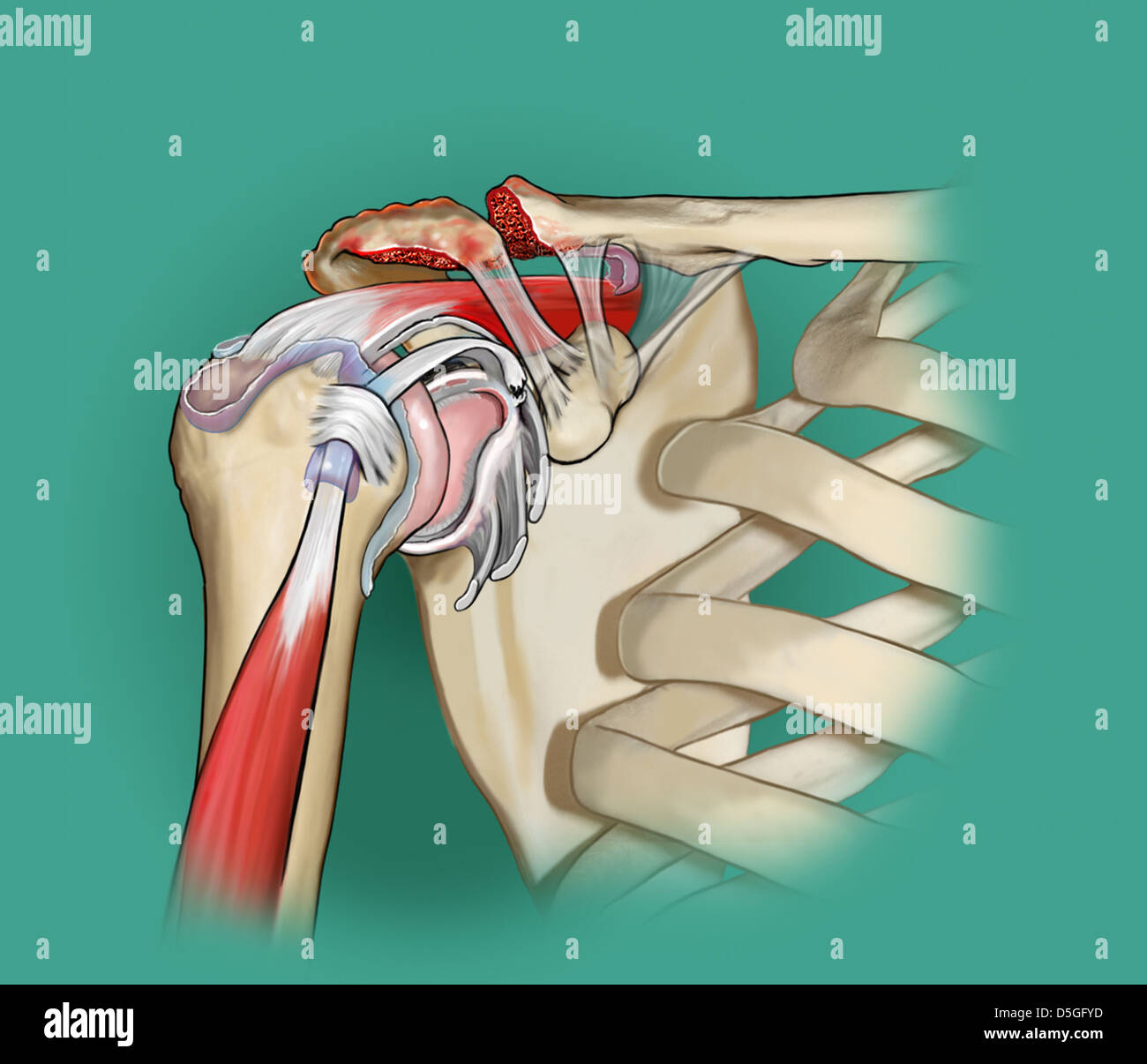 Arthroscopy Shoulder Surgical Distal Claviculectomy at Daniel Fisher blog