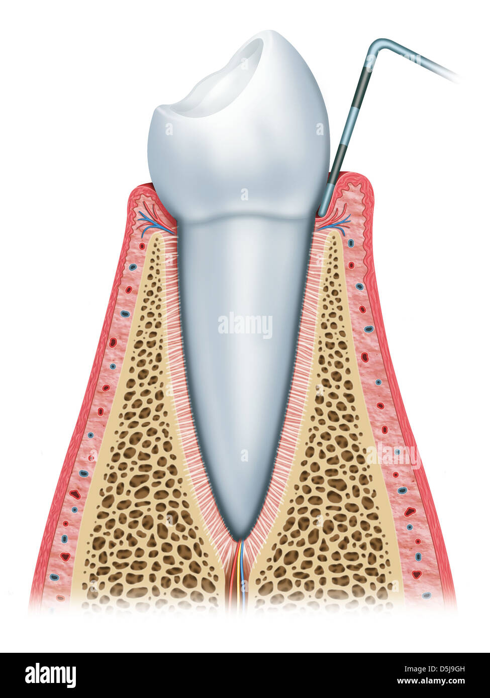 Acute gingivitis Cut Out Stock Images & Pictures - Alamy
