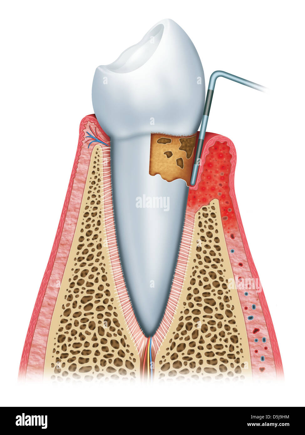 Gingivitis in its second stage Stock Photo - Alamy