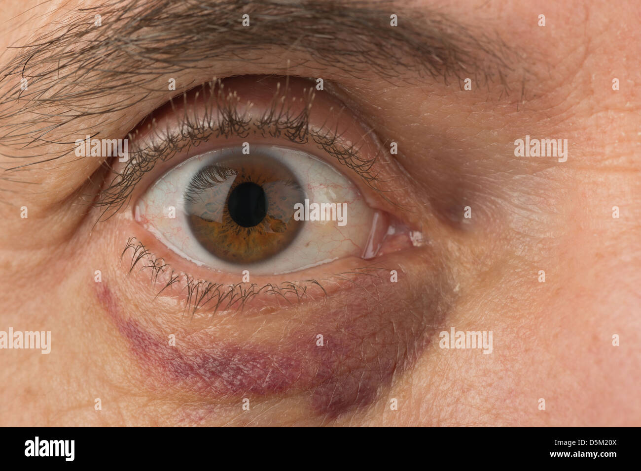 Black eye resulting from sports injury collision in crowded swimming ...