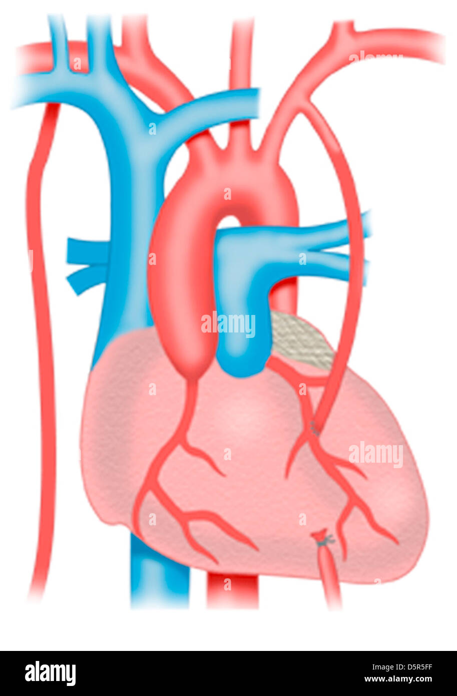 Coronary Artery Bypass Stock Photo - Alamy