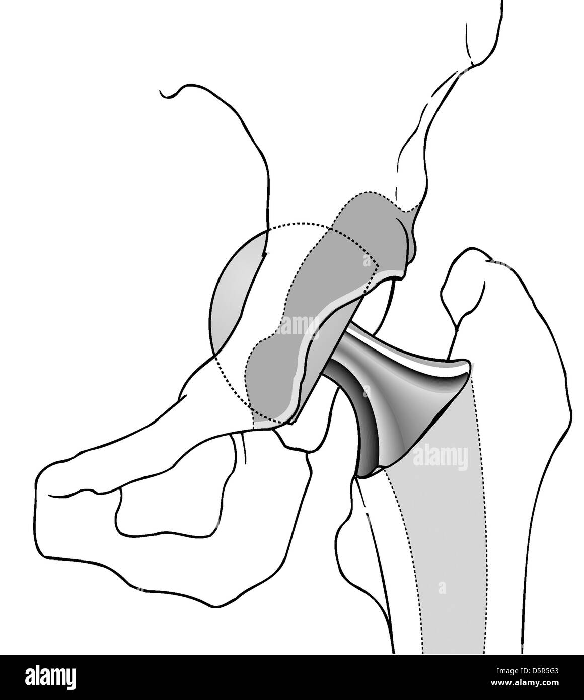 Hip replacement surgery Black and White Stock Photos & Images - Alamy