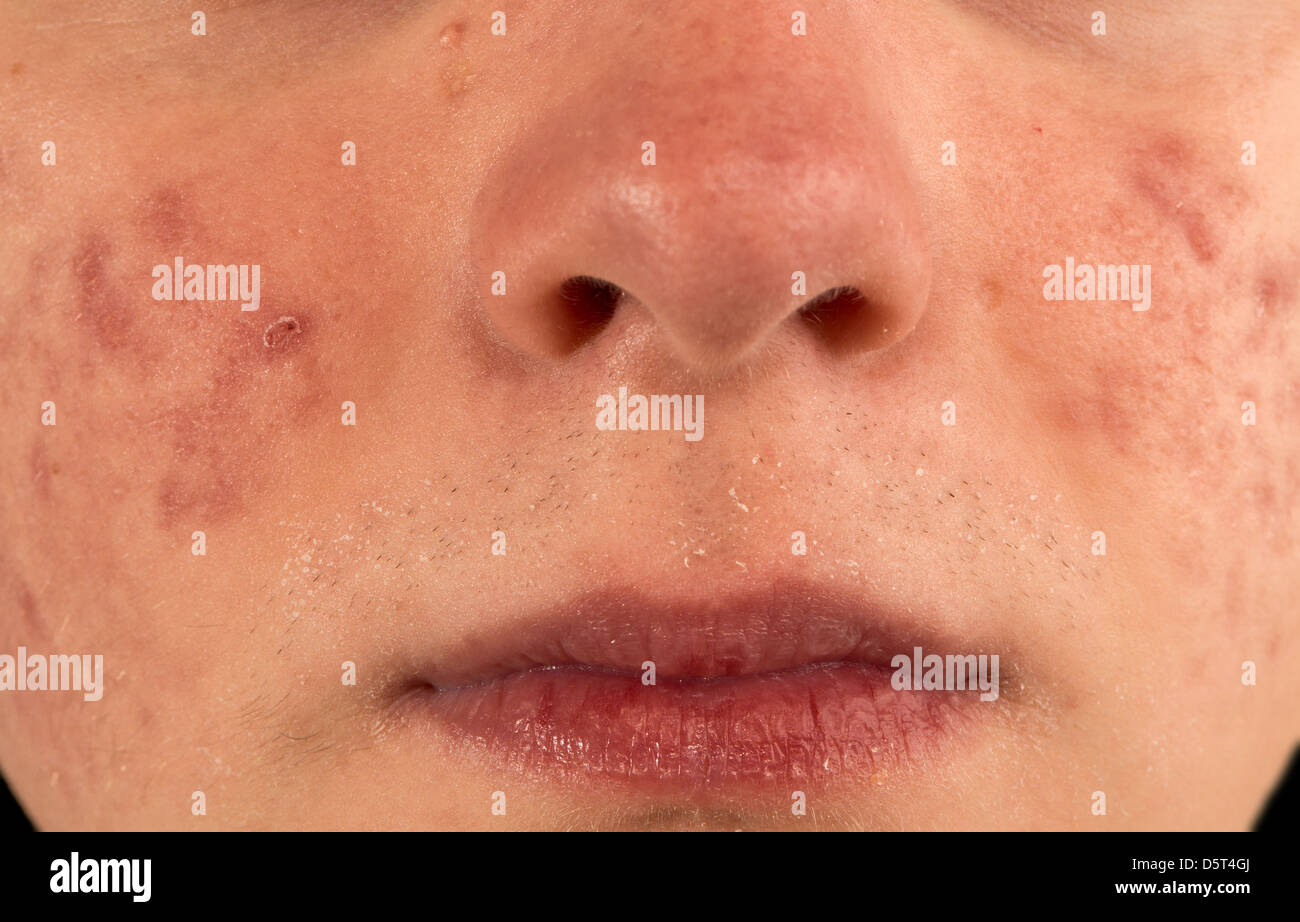 Acne hi-res stock photography and images - Alamy